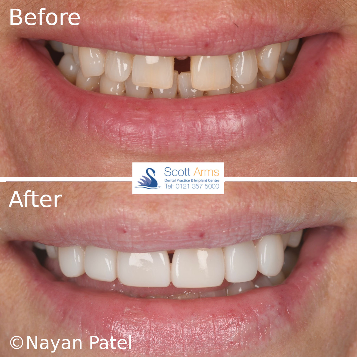Composite Bonding Birmingham - Scott Arms Dental Practice
